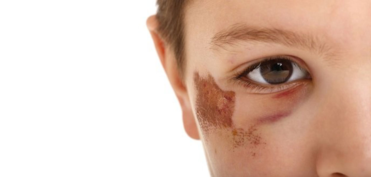 ¿Qué es un hematoma? | Piel Saludable