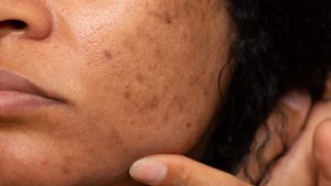 ¿Qué es el melasma? Causas, tipos y cómo tratarlo | Piel Saludable