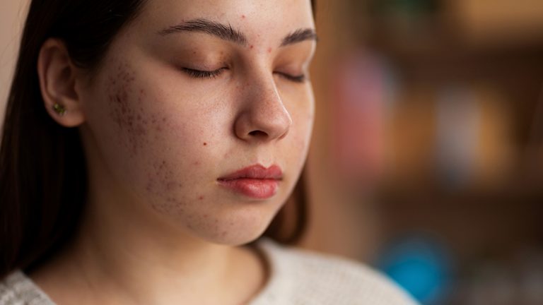 Manchas oscuras en la cara ¿cómo eliminarlas? | Piel Saludable