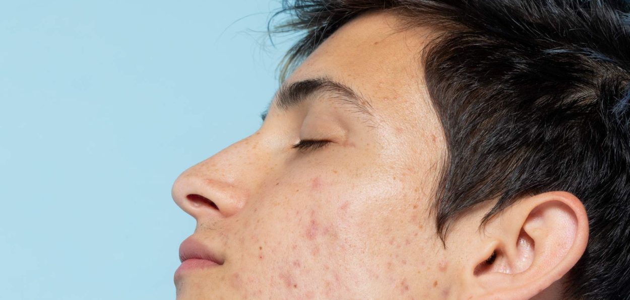 Foliculitis: qué es y cómo se trata | Piel Saludable