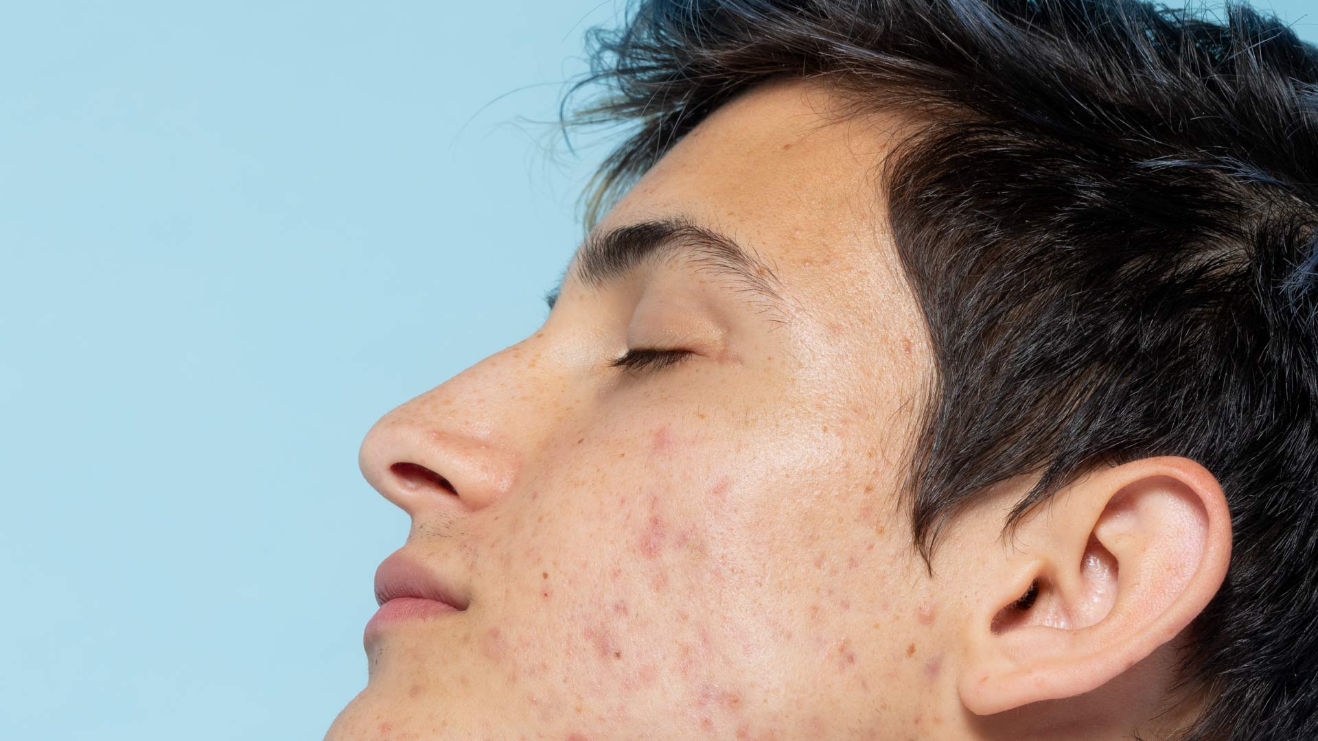 Foliculitis: qué es y cómo se trata | Piel Saludable